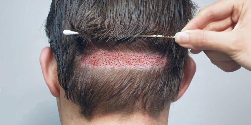 FUT Strip Hair Transplant - NoWigs